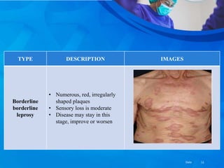 SKIN DISORDERS ADULT HEALTH NURSING-I LEPROSY.pptx