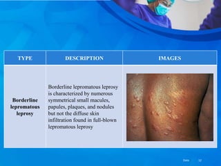 SKIN DISORDERS ADULT HEALTH NURSING-I LEPROSY.pptx