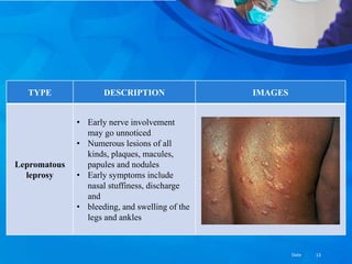 SKIN DISORDERS ADULT HEALTH NURSING-I LEPROSY.pptx