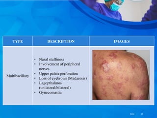 SKIN DISORDERS ADULT HEALTH NURSING-I LEPROSY.pptx