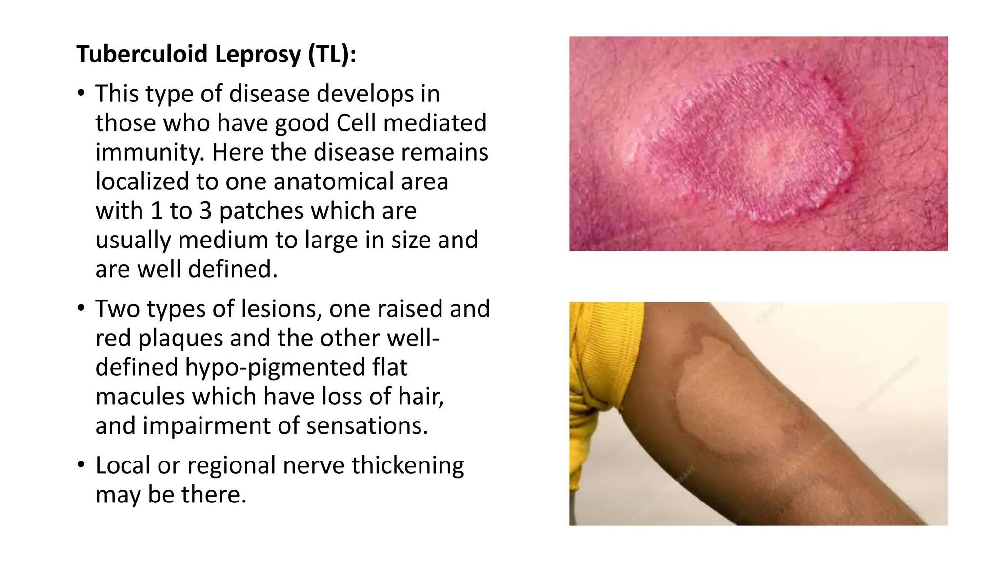 LEPROSY (Hansen disease) types, clinical features.pptx