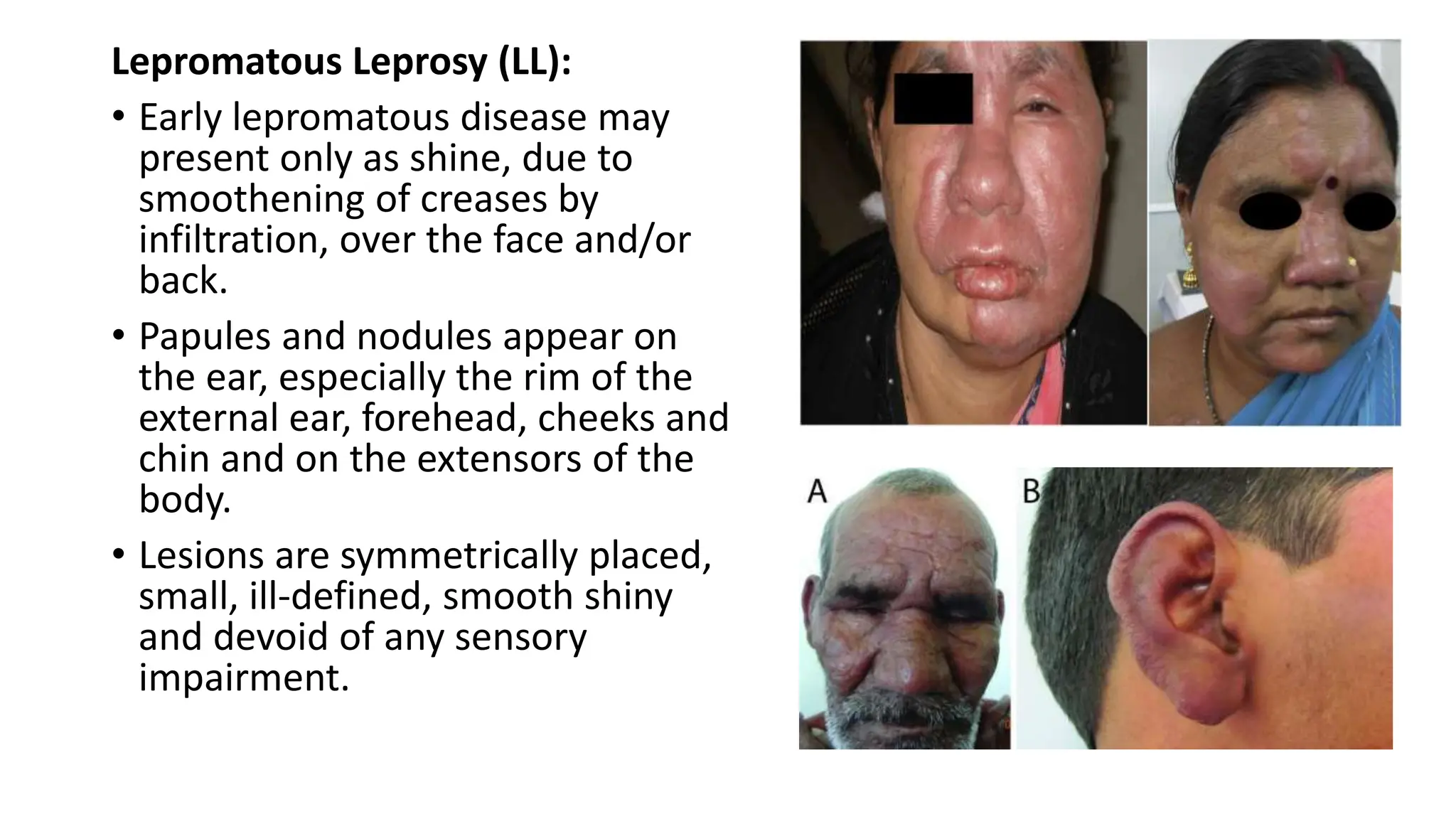 LEPROSY (Hansen disease) types, clinical features.pptx
