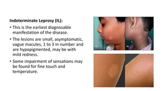 LEPROSY (Hansen disease) types, clinical features.pptx