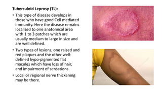 LEPROSY (Hansen disease) types, clinical features.pptx