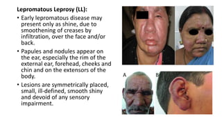 LEPROSY (Hansen disease) types, clinical features.pptx