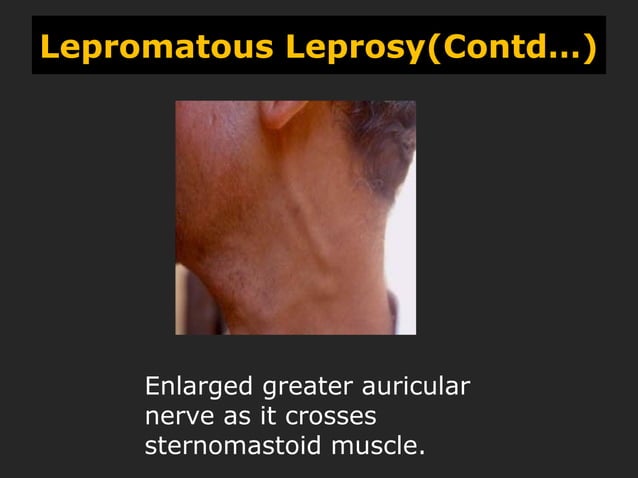 Leprosy, its types, causes, symptoms and treatment | PPT