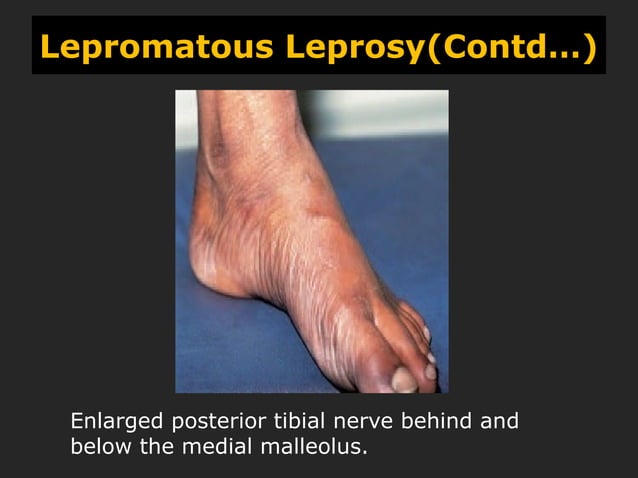 Leprosy, its types, causes, symptoms and treatment | PPT