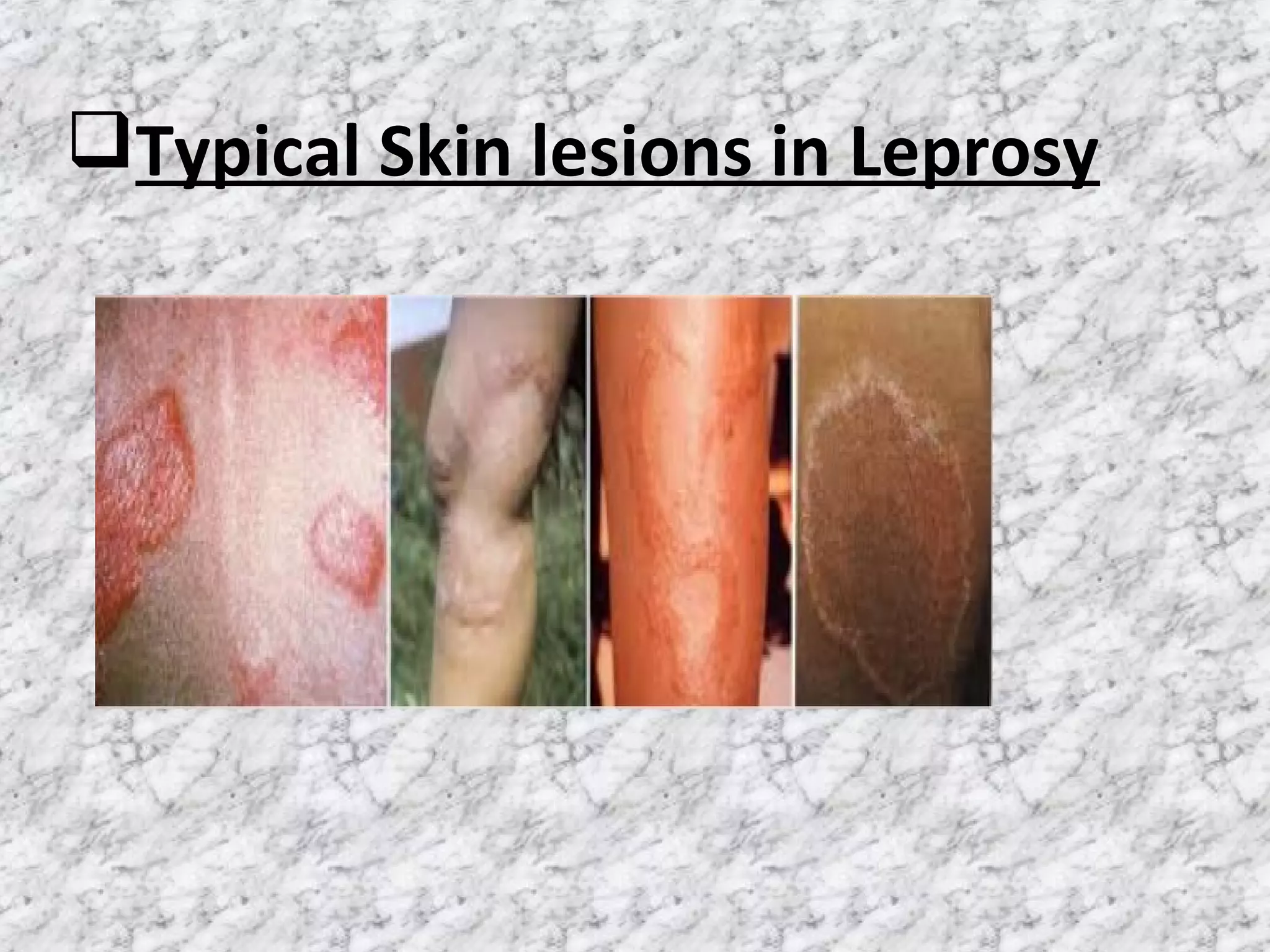 Leprosy | PPT