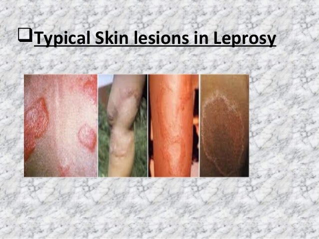 Leprosy
