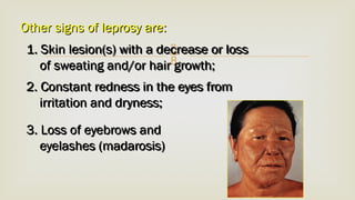 Here is the leprosy-presentation-updated.pptx