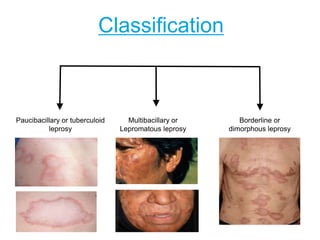 LEPROSY-WPS Office (1).pptx