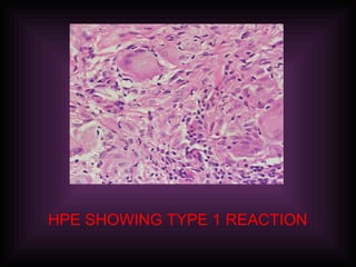 Leprosy (1).ppt hpe | PPT