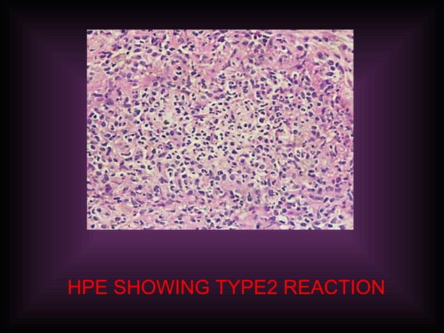 Leprosy (1).ppt hpe | PPT | Blood Disorders | Diseases and Conditions