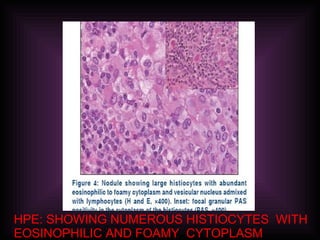 Leprosy (1).ppt hpe | PPT