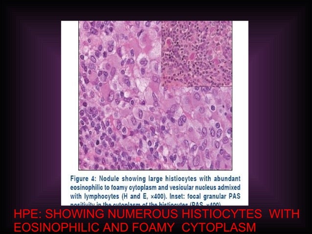 Leprosy (1).ppt hpe | PPT | Blood Disorders | Diseases and Conditions