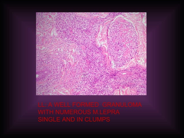 Leprosy (1).ppt hpe | PPT | Blood Disorders | Diseases and Conditions