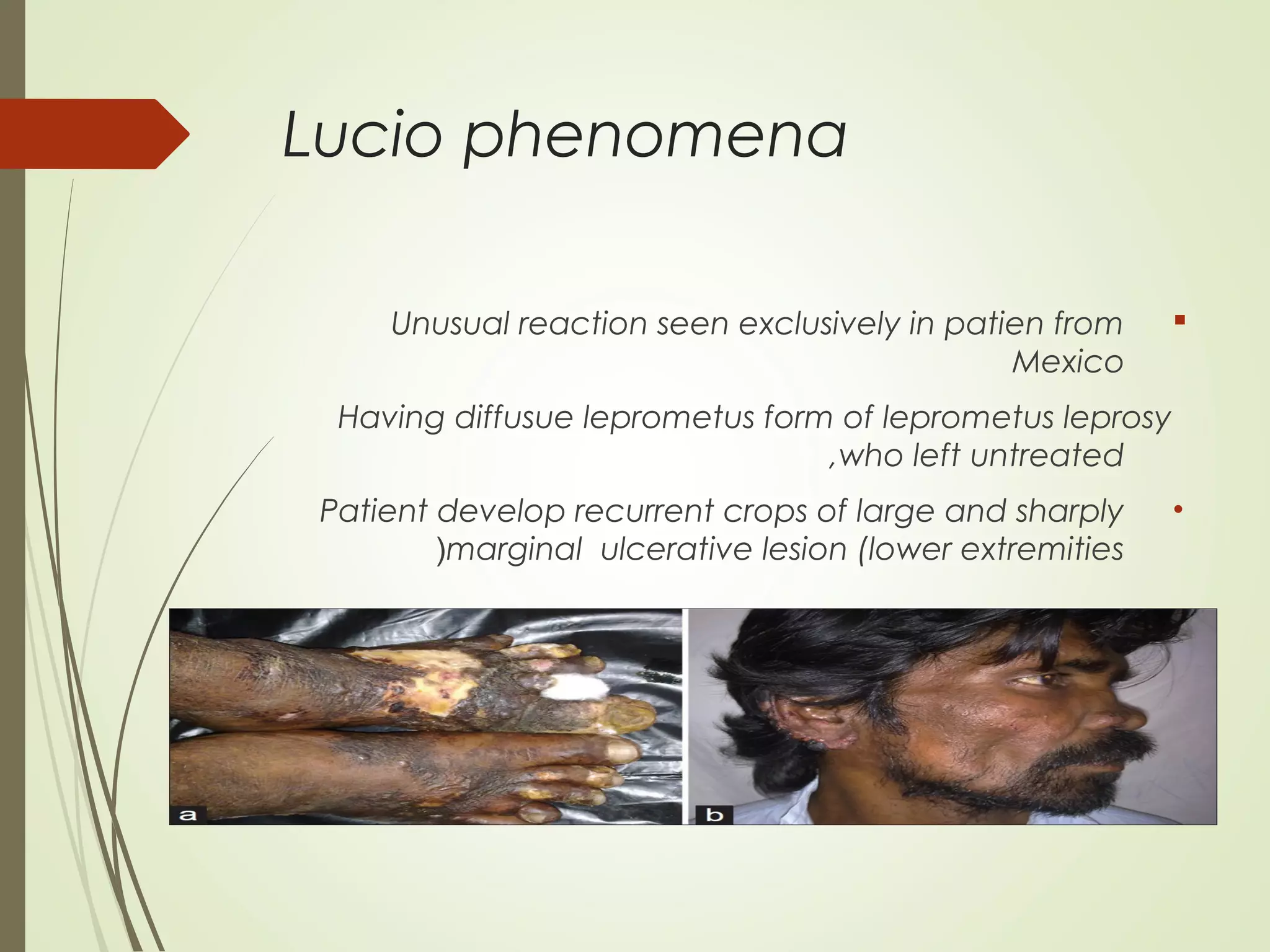 Leprosy by tanta university student | PPT