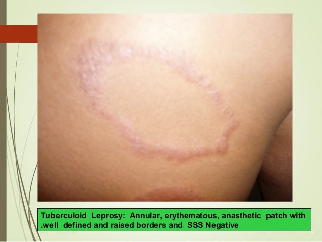 Leprosy by tanta university student