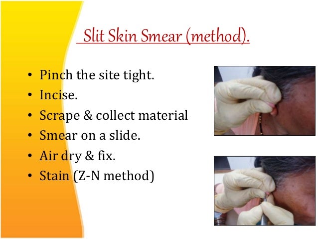 Leprosy and its immunology