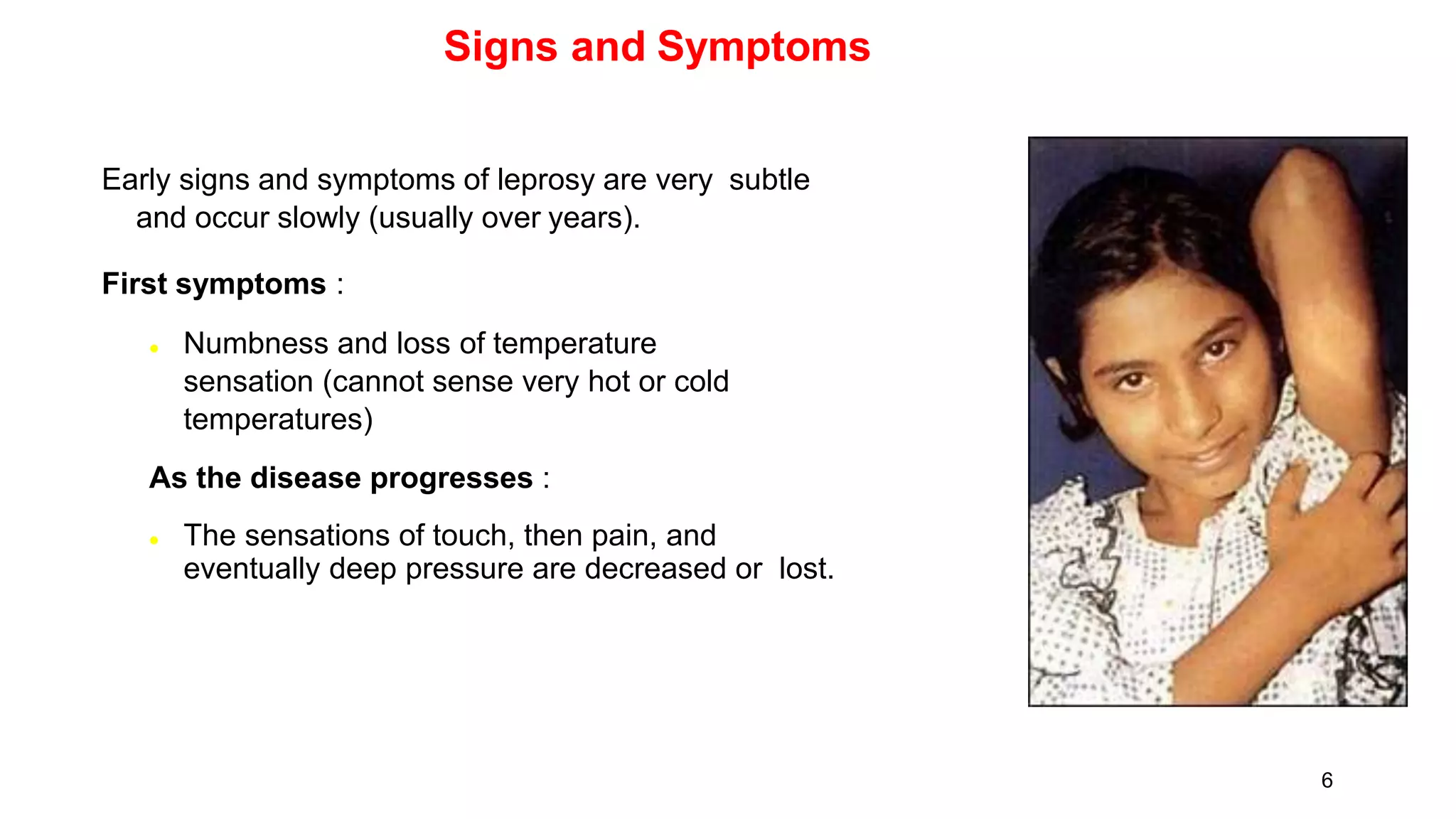 Leprosy by dr.faiqa | PPTX