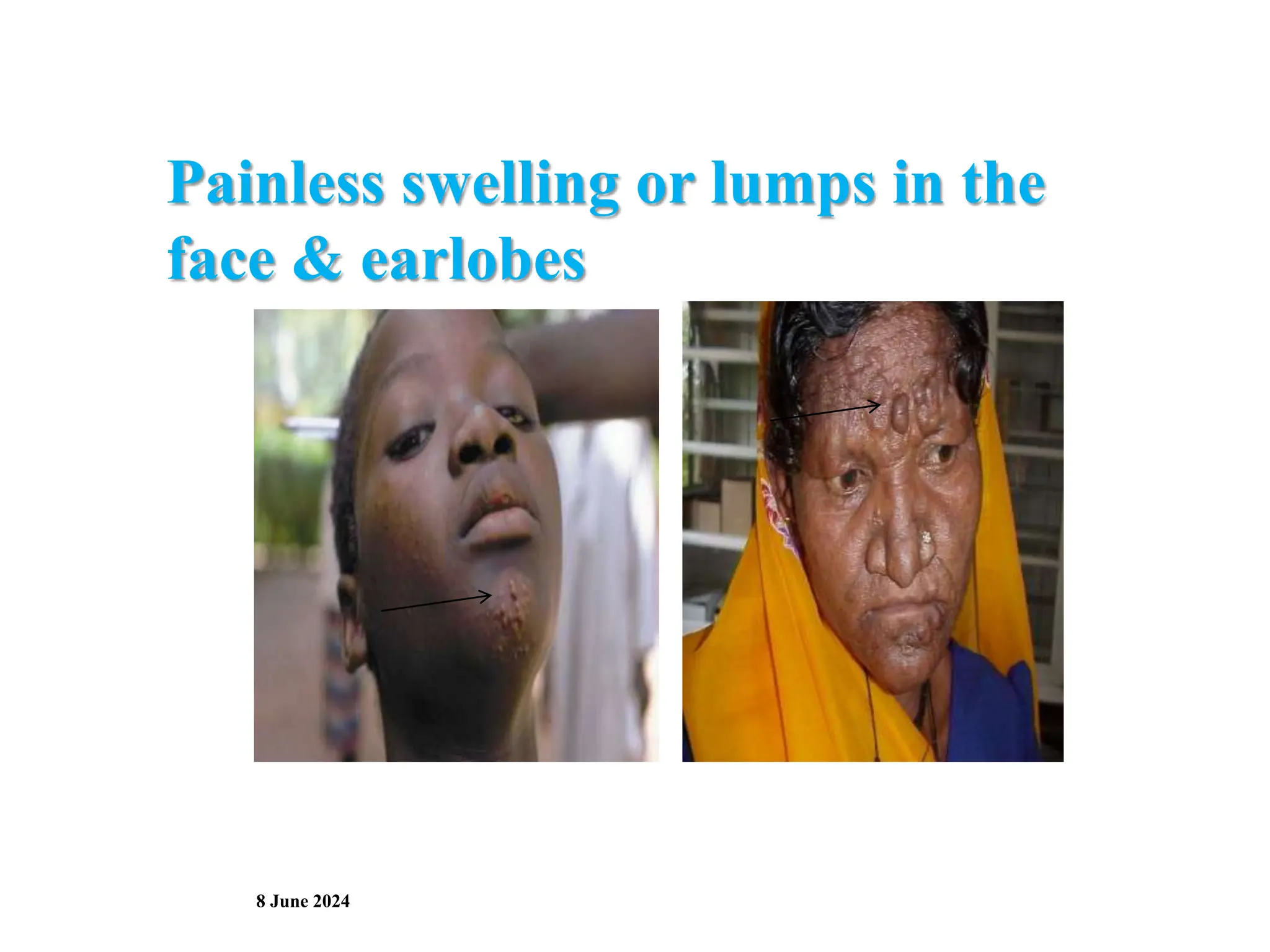 leprosy Case detection and diagnosis.pptx