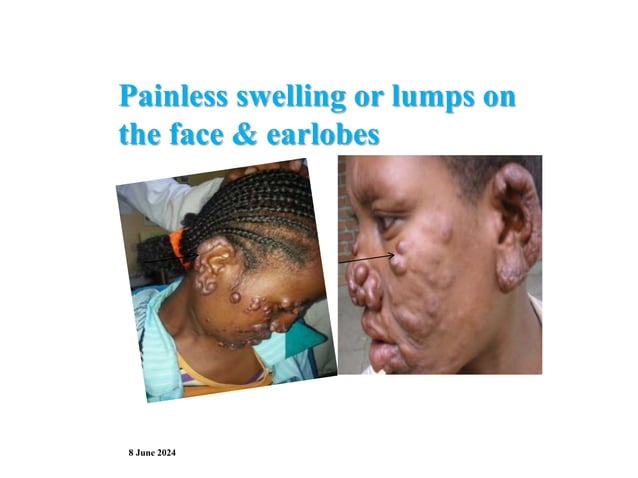 leprosy Case detection and diagnosis.pptx | Infectious Diseases ...