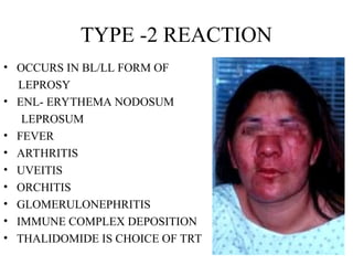 leprosy caused by Mycobacterium leprae bact | PPT