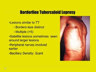 Leprosy -BASICS | PPTX | Infectious Diseases | Diseases and Conditions