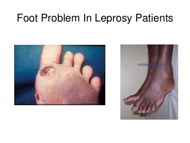 Complications of leprosy