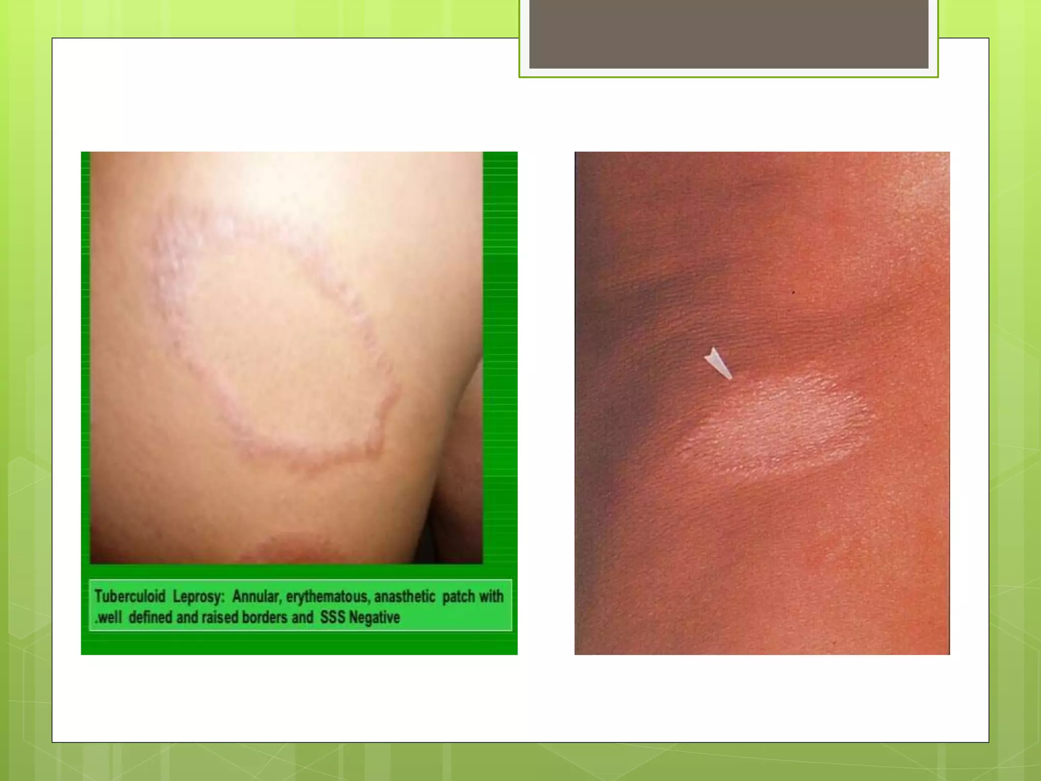 Leprosy - case definition and examination | PPTX