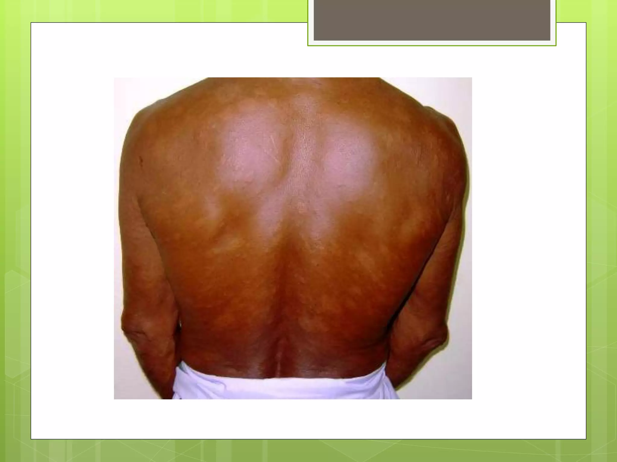 Leprosy - case definition and examination | PPTX