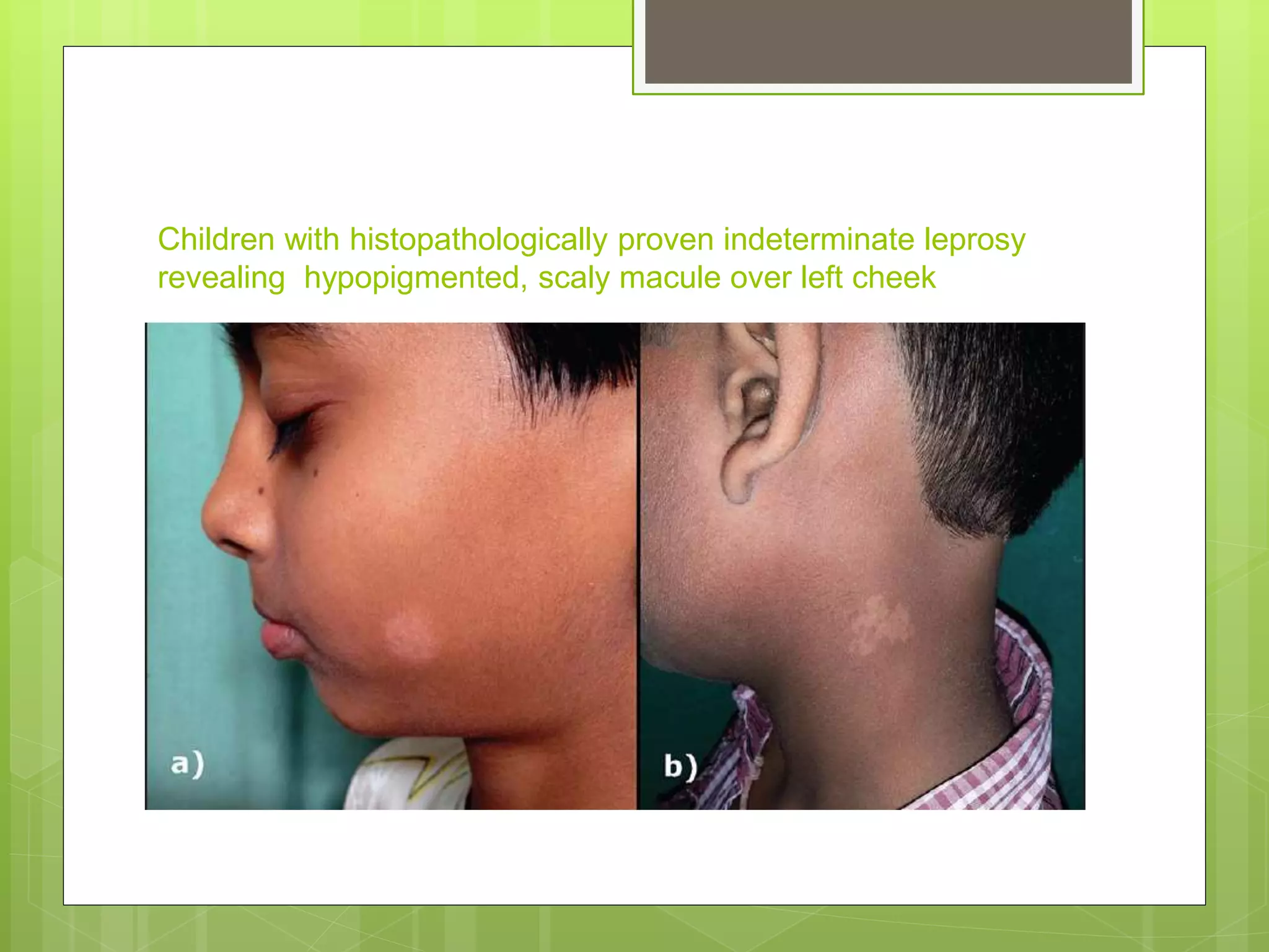 Leprosy - case definition and examination | PPTX