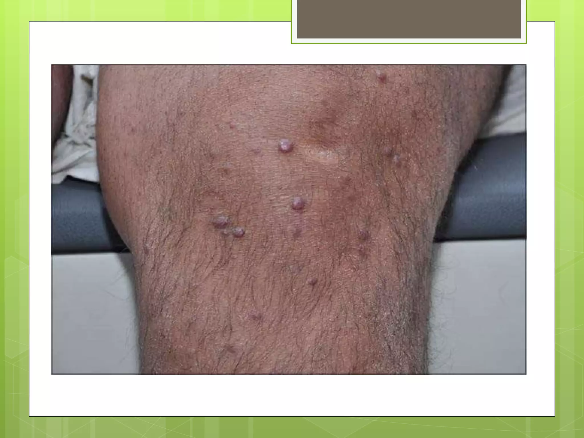 Leprosy - case definition and examination | PPTX