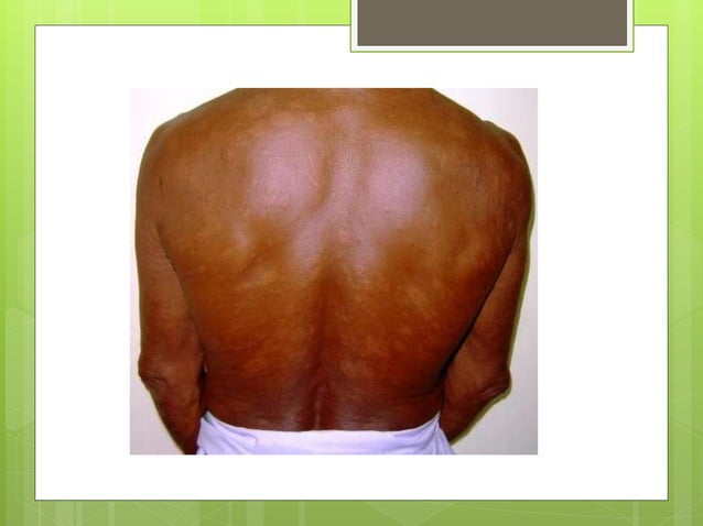 Leprosy - case definition and examination | PPTX