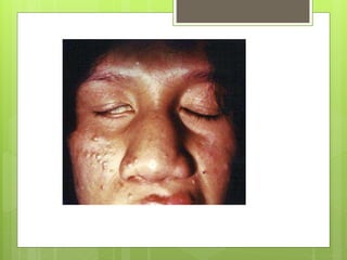Leprosy - case definition and examination | PPTX