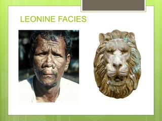 Leprosy Lion Face