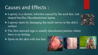 Leprosy free india | PPTX