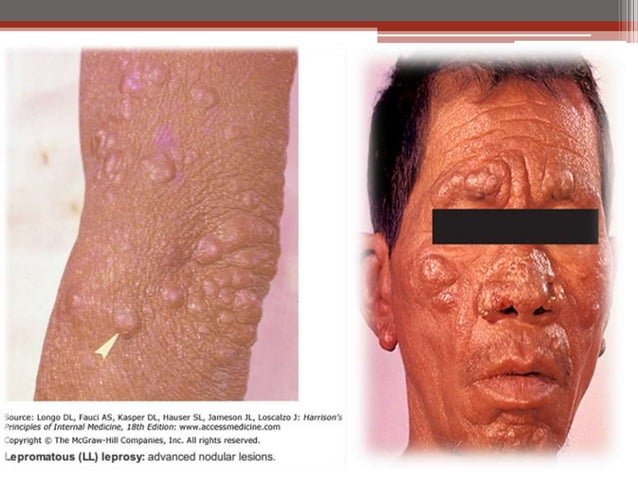 Leprosy ( hansen’s disease ) | PPTX