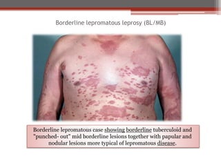 Leprosy ( hansen’s disease ) | PPTX