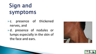 Leprosy in english leprosy | PPTX