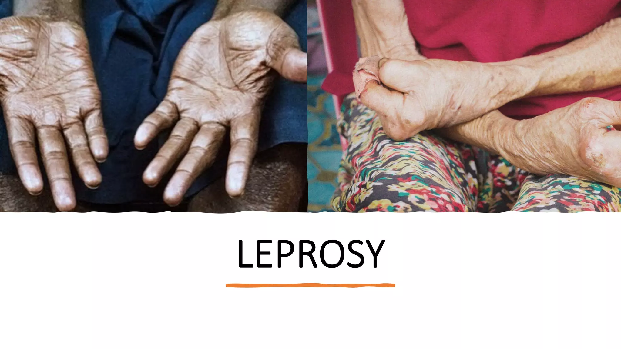 Leprosy microbiology | PPT