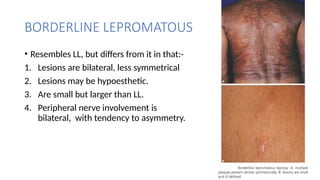 LEPROSY NERVE DEMONSTRATION AND EXAMINATIONpptx | PPTX