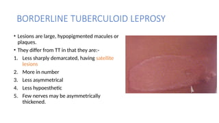 LEPROSY NERVE DEMONSTRATION AND EXAMINATIONpptx | PPTX