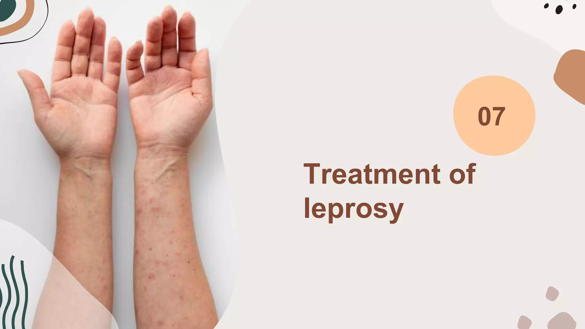 Leprosy and antileprotic drugs | PPT