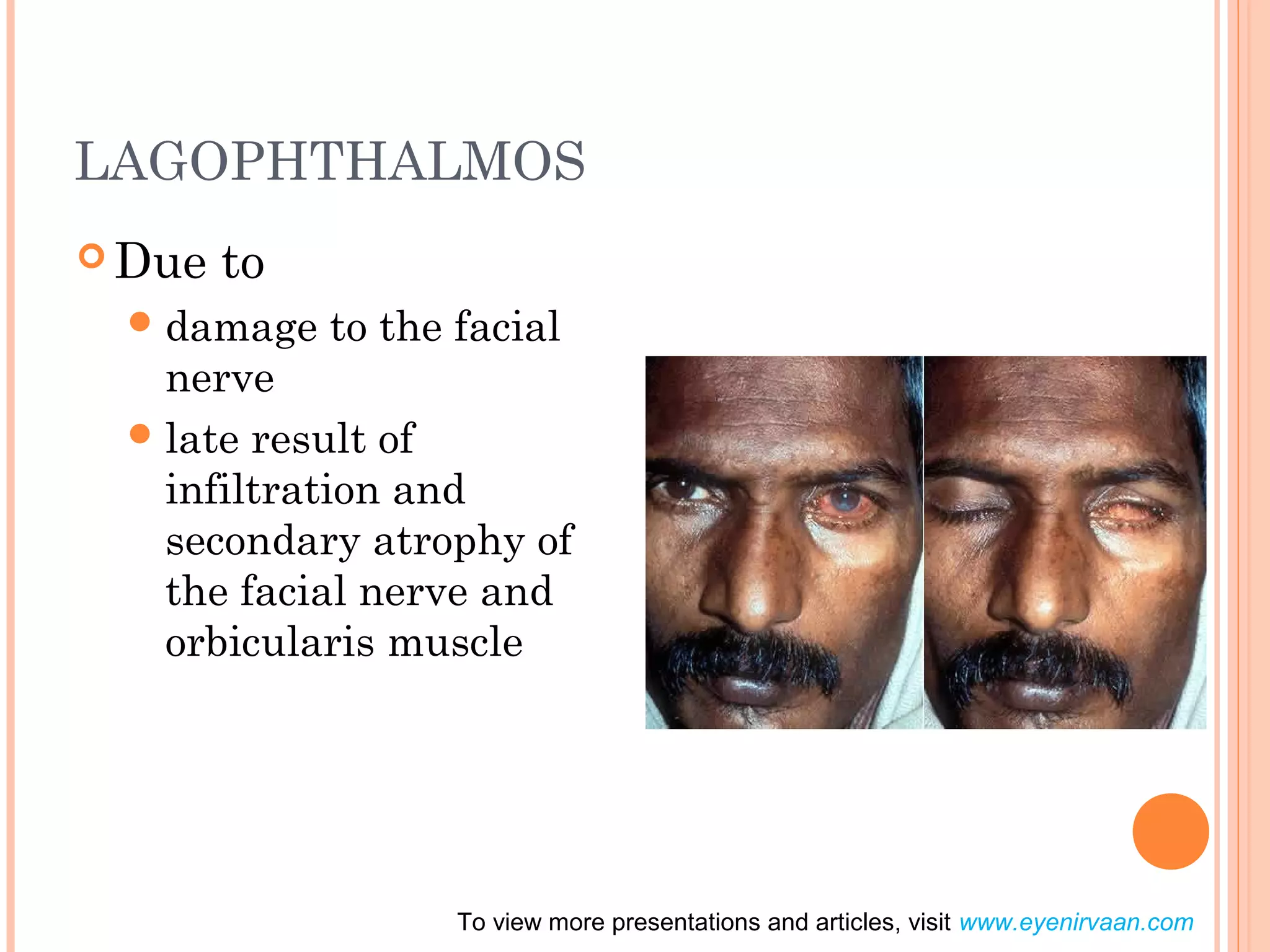 Leprosy part 2 - a presentation at www.eyenirvaan.com