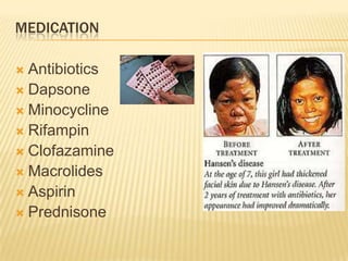 Leprosy power point presentation | PPTX
