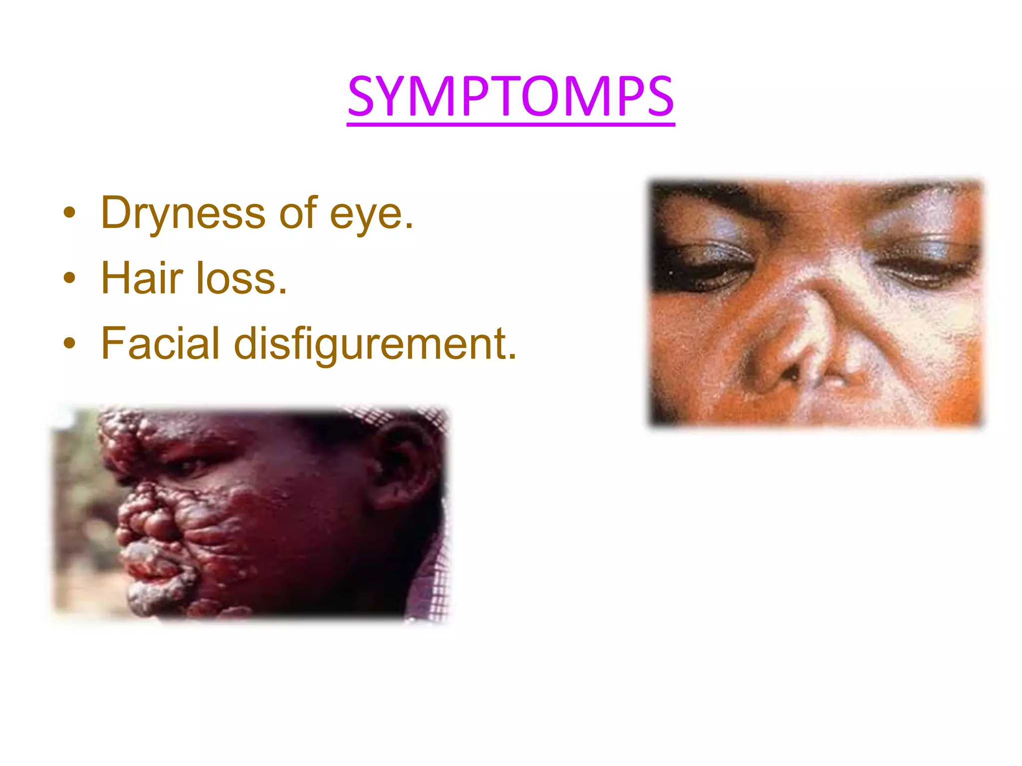 Leprosy | PPTX