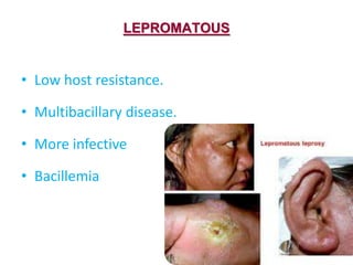 Leprosy | PPTX