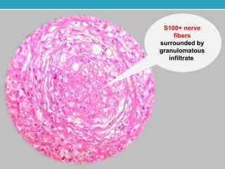 Atypical presentations of erythema nodosum leprosum: a case report and ...