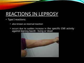 LEPROSY and Rehabilitation process of leprosy | PPTX